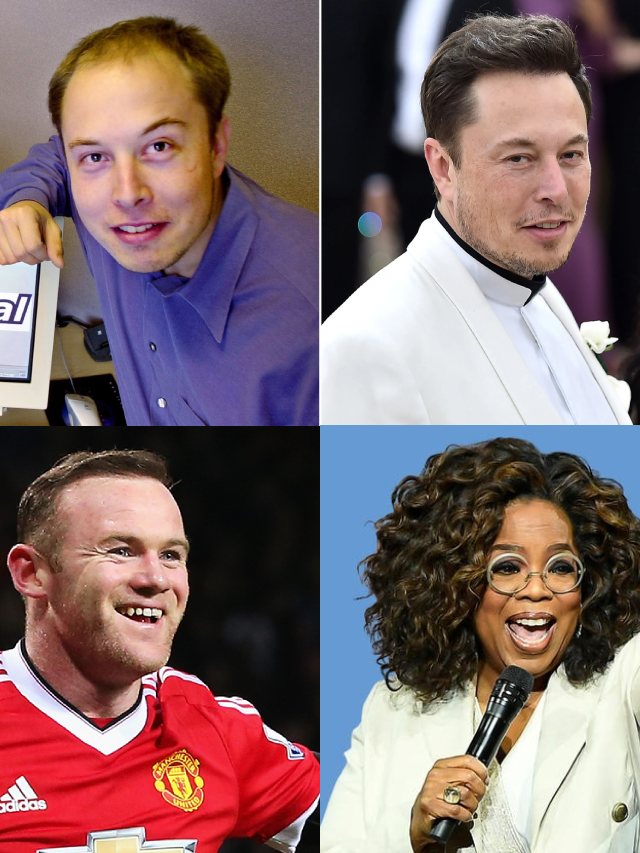 Celebrities Who Have Gotten A Hair Transplant - Sportskeeda Stories